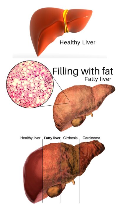 Fatty Liver Causes - The Simple Self Care Lifestyle